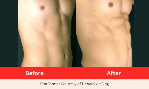 Magnetic Body Sculpting - San Diego Varicose Vein Treatment Center