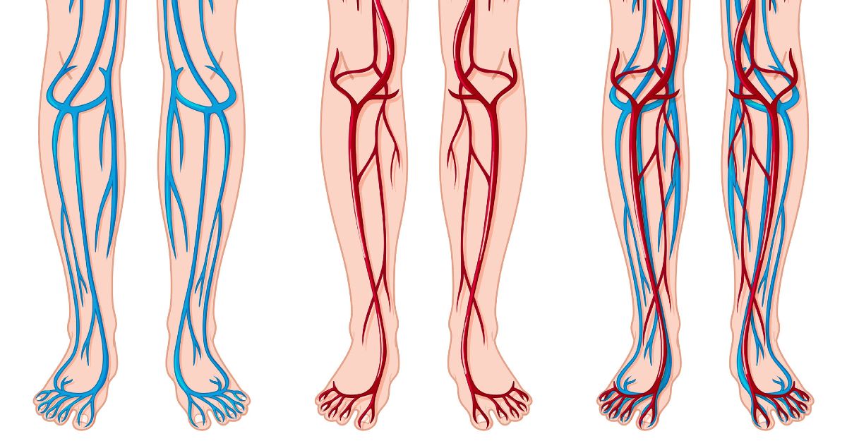 Phlebology and the Phlebologist Specialty - San Diego Cardiac Vein and ...